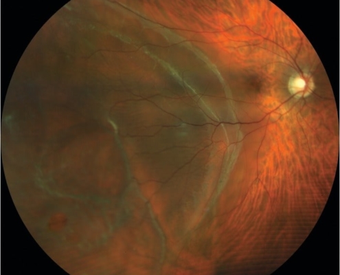 Zeiss Clarus 500 | Cámara Retinal HD de Campo ultra Amplio | AstaTec