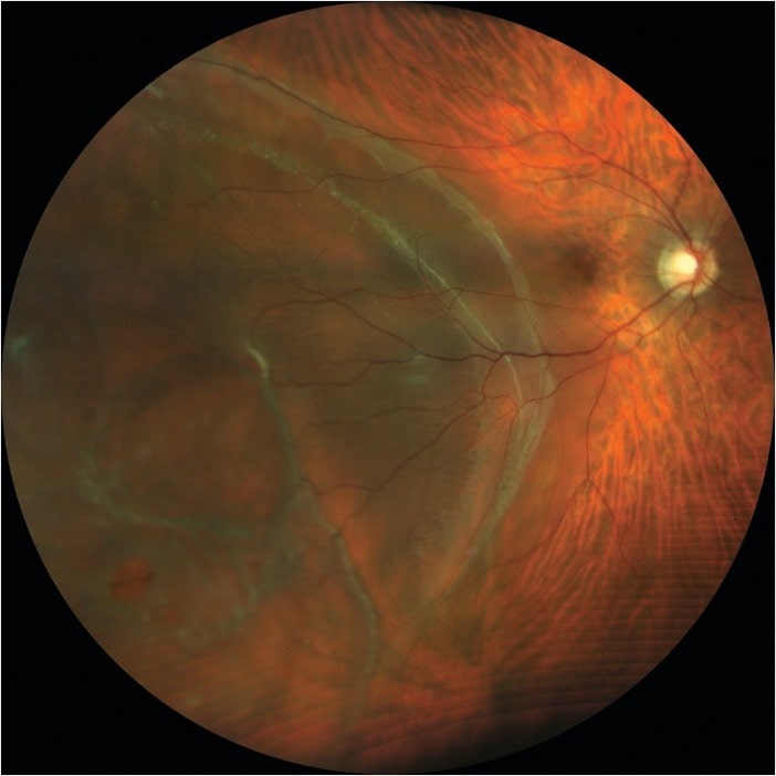 Zeiss Clarus 500 | Cámara Retinal HD de Campo ultra Amplio | AstaTec