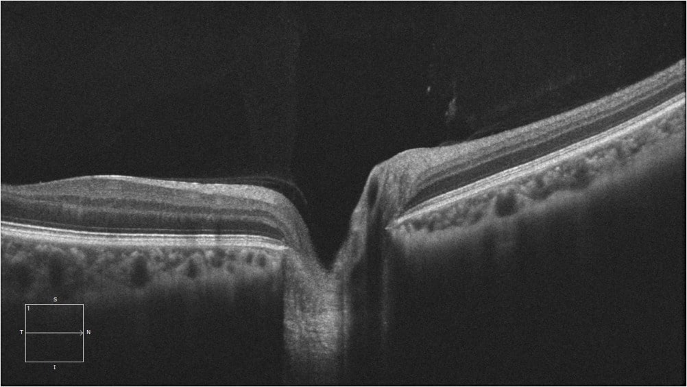 ZESS Cirrus HD | OCT | AstaTec