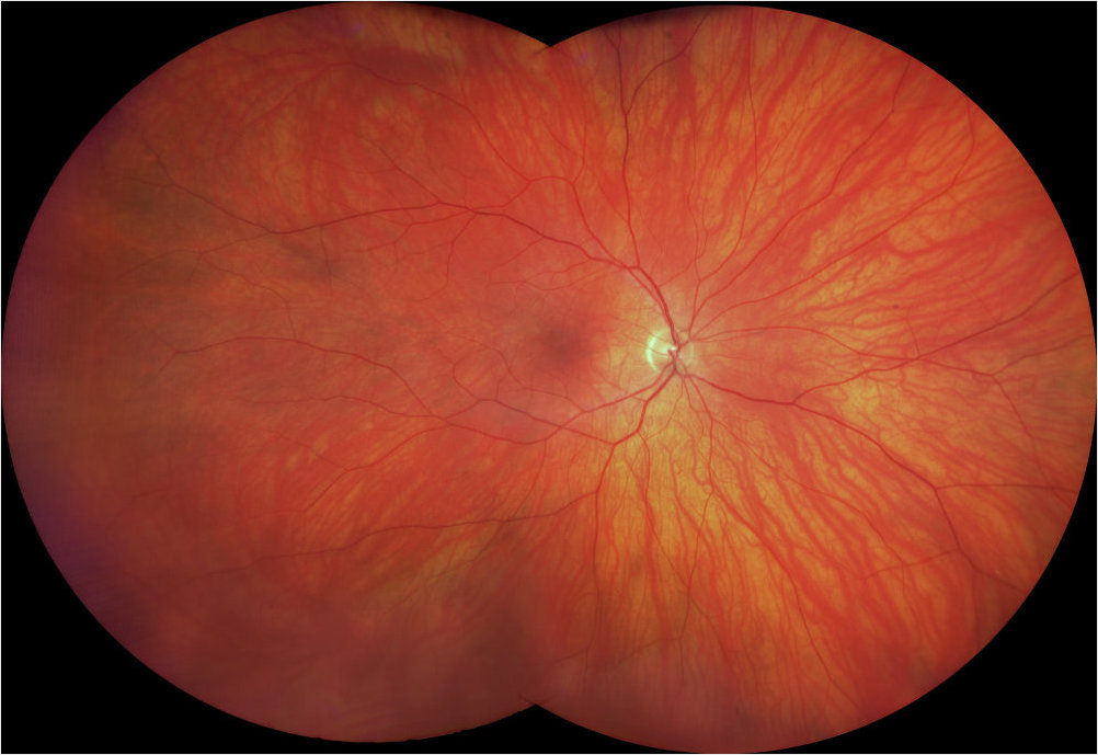 Zeiss Clarus 700 | Cámara Retinal HD de Campo Ultra Amplio | AstaTec